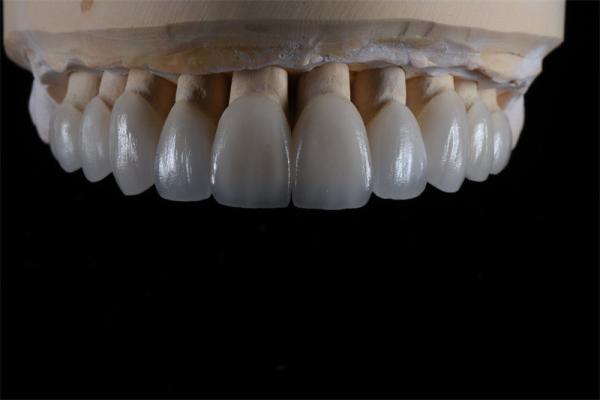 Quality Veneers Stain Resistant Comfortable Fit for sale