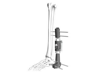 China Infected Nonunion Orthopedic External Fixation Device With Hex Wrench for sale