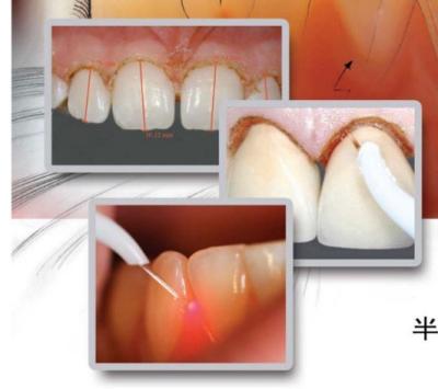 China Dental Tooth Whitening Machine dental laser teeth whitening for sale