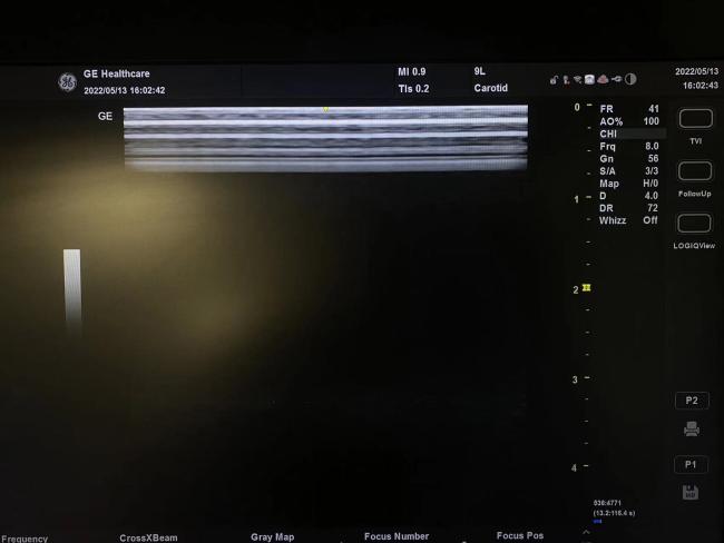 GE VividE 9L-RS Linear Ultrasound Probe - Professional medical imaging transducer