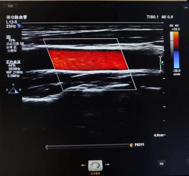 ATL EPIQ7 C5-1 convex array ultrasound probe