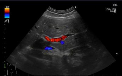 중국 히타치 알로카 F37 오리지널 콩벡스 3D/4D 초음파 탐사기 ASU-1014 판매용