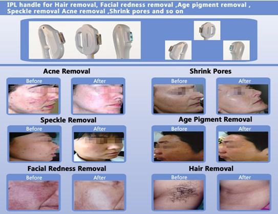 Portable Safe E-light IPL RF , Face Lifting Skin Rejuvenation Epilation Beauty Device