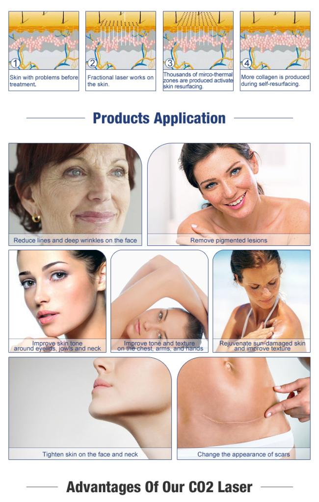 Fractional co2 laser scar removal/Co2 fractional laser /fractional Co2 laser