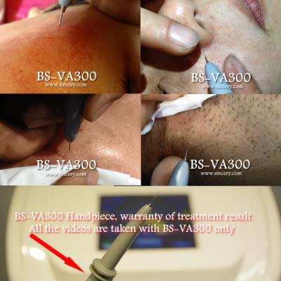 China Vascular Therapy Red Spider Veins Removal Machine for sale