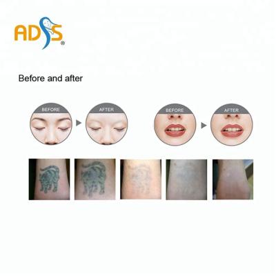 Cina Macchina di rimozione del tatuaggio del laser di Yag del commutatore ODM/dell'OEM Q 2 anni di garanzia in vendita