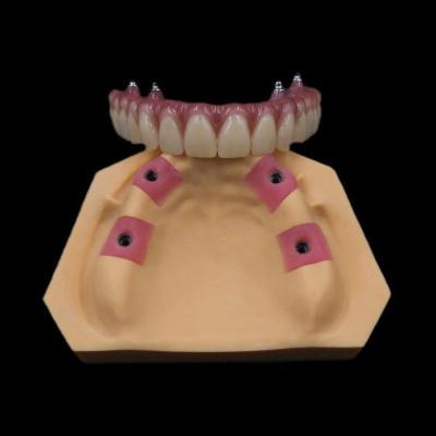 China China Dental Lab PFM Crown Enhanced Strength Natural Aesthetic Integration for sale