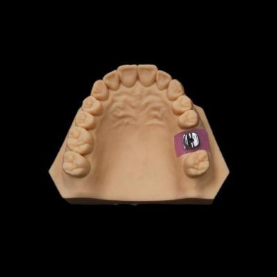 China Dental Implant Screw PFM Richmond Crown Biomechanical Strength Osseointegration for sale