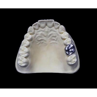 China Endodontically Treated Teeth FCC Crown Full Cast Crown Richmond Crown for sale