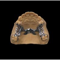 China Biocompatible Dental Metal Framework Cobalt-Chromium Titanium Precision Fit for Removable Partial Dentures for sale