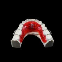 China Customizable Hyrax Palatal Expander for Crossbite Correction Metal Orthodontic Appliance for sale
