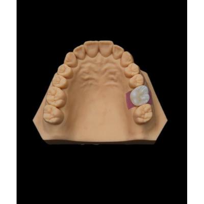 China PFM Dental Implant Cement For Edentulous Restoration With Chrome Cobalt for sale