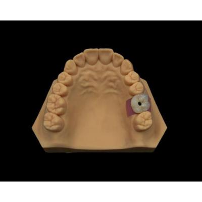 China Chrome Cobalt PFM Implant Screw Ceramic Powder Coating Reusable Abutment for sale