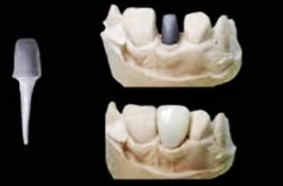 China Chrome Cobalt Dental PFM Richmond Crown For Restoring Limited Space for sale