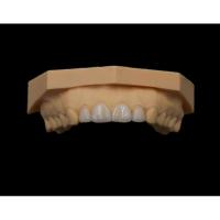 Quality High Translucency Dental Emax Crown Superior Esthetics For Dental Restorations for sale