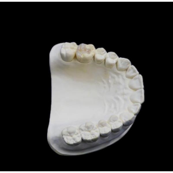Quality Tiny Hole Restoration Composite Inlay Dental Caries Treatment for sale