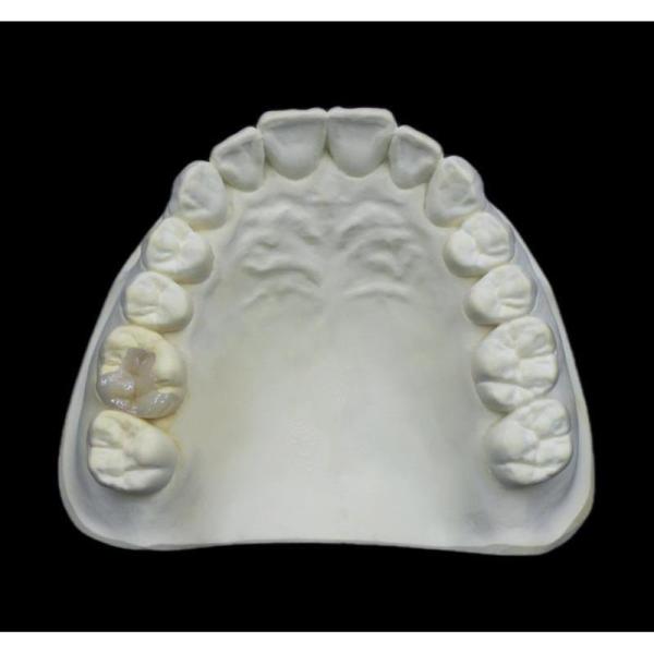 Quality Tiny Hole Restoration Composite Inlay Dental Caries Treatment for sale