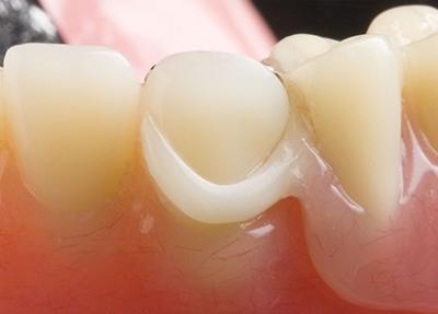 China Ental Prosthetics Acetal Clasp Acrylic Denture Clasps For Secure Hold for sale