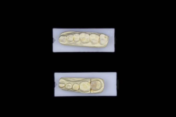 Quality Minimally Invasive Dental Composite Inlay Posterior Teeth Restoration for sale