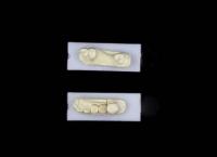 Quality Teeth Restoration Composite Inlay Minimally Invasive Inlay Core Composite for sale