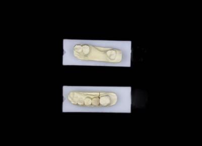 China Teeth Restoration Composite Inlay Minimally Invasive Inlay Core Composite for sale