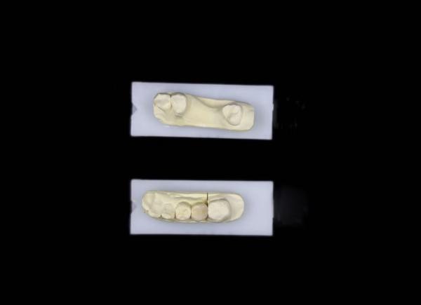 Quality Teeth Restoration Composite Inlay Minimally Invasive Inlay Core Composite for sale