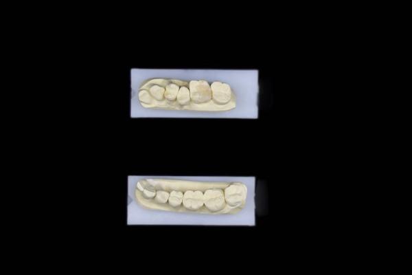 Quality Teeth Restoration Composite Inlay Minimally Invasive Inlay Core Composite for sale