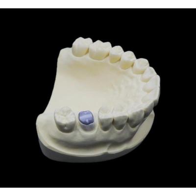 China Single Piece Post And Crown Restoration Enhanced Stability Superior Aesthetic Outcomes for sale