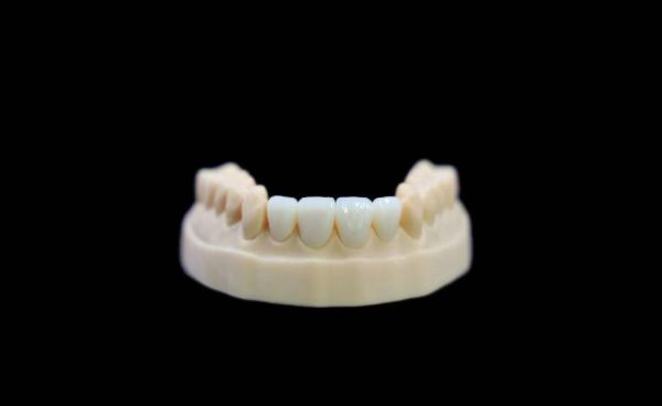 Quality Lithium Disilicate All Ceramic Emax Crown Dental Restoration Proven Strength for sale
