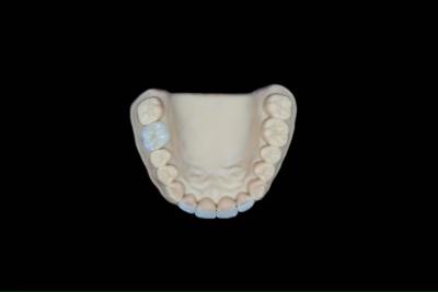 China E Max Crown Lithium Disilicate All Ceramic Dental Restoration With Exceptional Aesthetics for sale