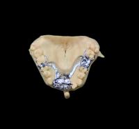 China Nickel Chromium CAD CAM Metal Framework for Cast Partial Denture Base 1.2mm Thickness for sale