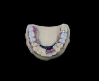 China Nickel Chromium CAD CAM Metal Framework for Cast Partial Denture Base 1.2mm Thickness for sale