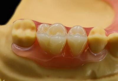 China Dental Lab China Prosthesis Valplast Denture Flexible Partial Denture Biocompatible for sale
