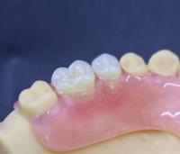 Quality Removable Adjusting Valplast Partials High Flexibility Chinese Dental Lab for sale