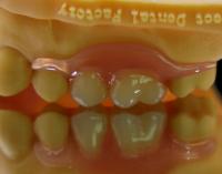 Quality Valplast Denture for sale
