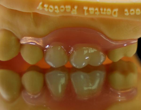 Quality ShenZhen Dental Lab Metal Free Valplast Denture Flexible Fracture Resistance for sale