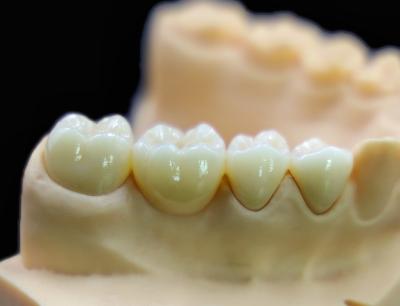 China Metal Free Chinese Dental Lab CAD / CAM Full Zirconia Crown for sale
