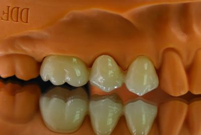China CAD CAM Modern Dental Lab China Zirconia Full Contour Crown High Strength for sale