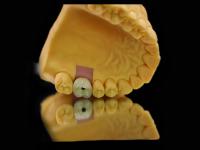 Quality Dental Implant for sale