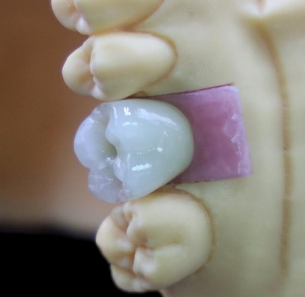 Quality Tapered Cylindrical Hybrid Dental Implant System Internal Connection for sale