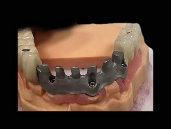 Quality Titanium Digital Dental Solutions Lab 3.75mm-4.5mm Diameter Screw Retained for sale