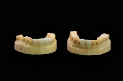 China Translucency Dental Veneer Stain Resistance Porcelain Veneer Dental Lab ShenZhen for sale