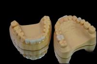 Quality Stain Resistance Dental Veneer Minimally Invasive Porcelain Veneer Teeth for sale