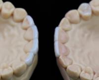 Quality Translucency Dental Ceramic Veneer Custom Made Chinese Dental Lab for sale