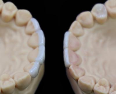 China Translucency Dental Ceramic Veneer Custom Made Chinese Dental Lab for sale
