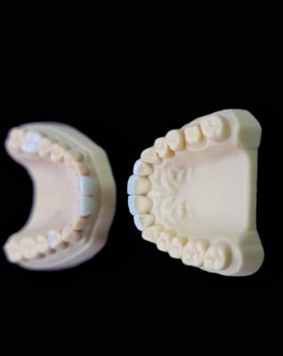 China Porcelain Veneer Teeth China Dental Lab Outsourcing Dental Veneers Stain Resistance for sale
