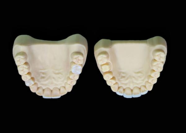 Quality Permanent Teeth Ceramic Veneer Translucency China Outsourcing Dental Lab for sale
