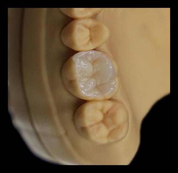 Quality China Dental Lab Emax Inlay Lithium Disilicate CE Marked Heat Pressed Dental Inlay for sale