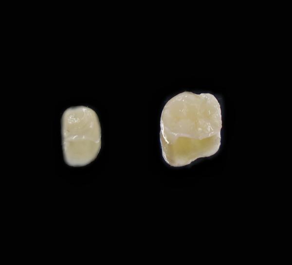 Quality Dental Laboratory China Emax Inlay Lithium Disilicate CE E Max Inlay for sale