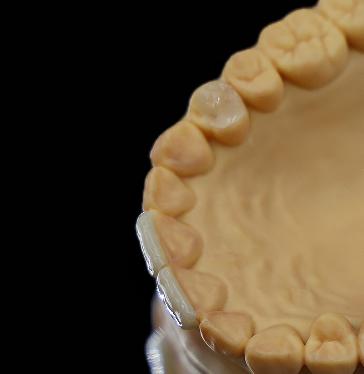 Quality China Dental Outsourcing Dental Inlay Lithium Disilicate CE Marked for sale